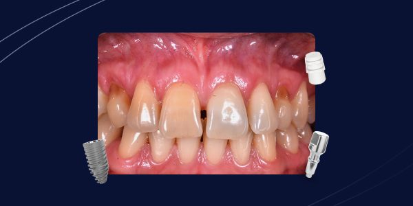 Benefício do uso de componentes anguláveis personalizados em casos de ...