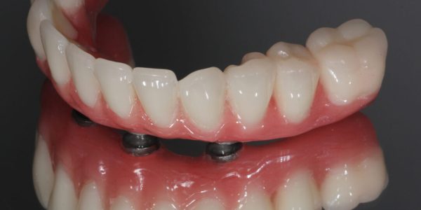 Prótese Dentária: Um Guia Completo - FGM Dental Group